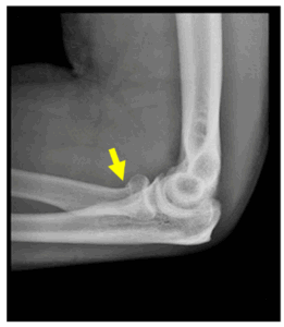 Radial head/neck (elbow) fracture Patient Information Leaflet - The ...