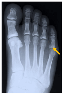 Lesser toe fracture Patient Information Leaflet - The Princess ...